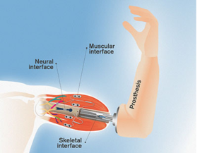 New Day Dawning for Smart Prosthetics - Amplitude