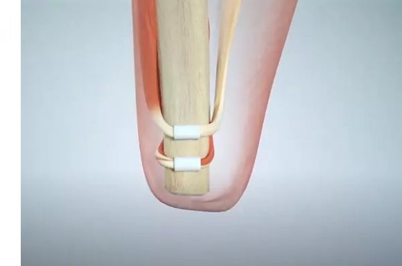 AMI Amputation Surgery: A Layperson's Guide | Amplitude